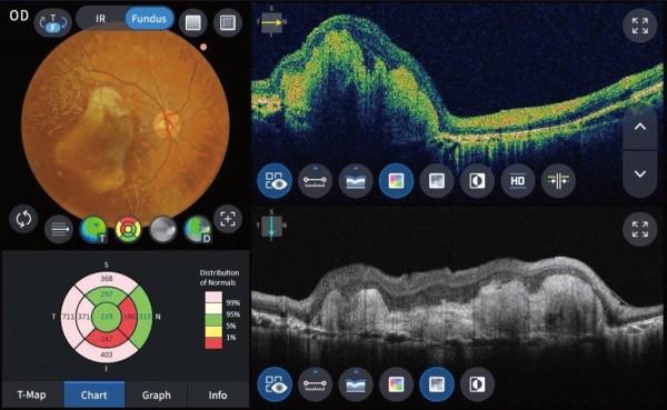 Huvitz Launches 5-in-1 Optical Coherence Tomography Device 'HOCT'| Huvitz