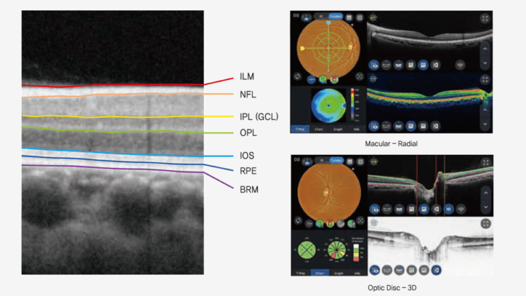 OCT for Early Detection of Eye Diseases (Huvitz HOCT-1/1F)| Huvitz