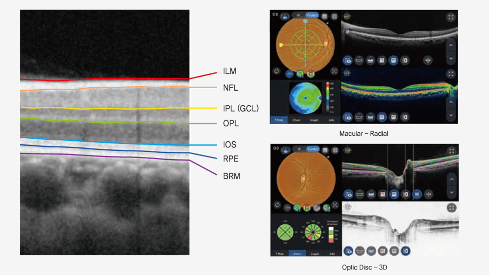 OCT for Early Detection of Eye Diseases (Huvitz HOCT-1/1F)| Huvitz