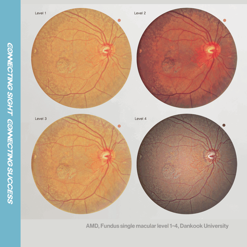 True Color Retinal Imaging with OCTavius Fundus Camera | Latest ...